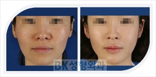 BK Plastic Surgery: Cheekbone Reduction at BK Plastic Surgery Hospital